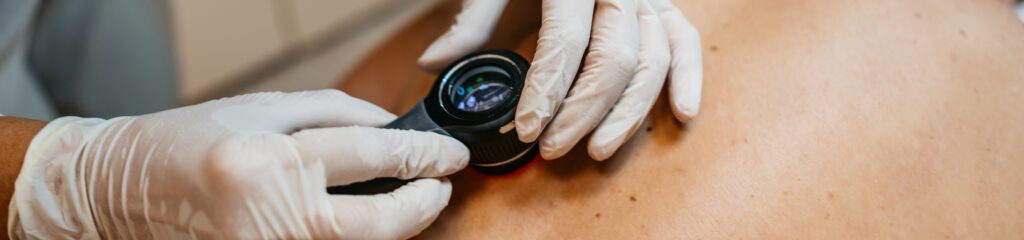 MOHS Surgery Leesburg FL - Chemosurgery Leesburg FL