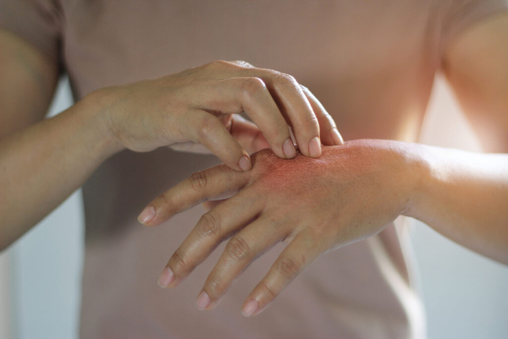 Skin Allergy Testing Leesburg - Allergy Treatment Florida